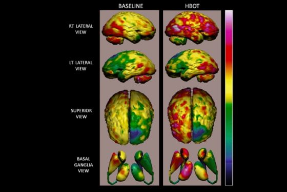 A Closer Look at How Hyperbaric Oxygen Therapy Works