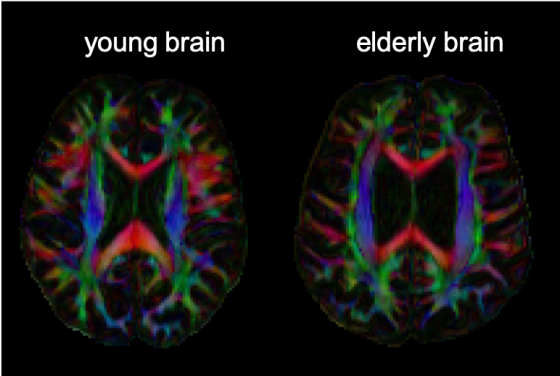 What Does White Matter Say About the Aging Brain